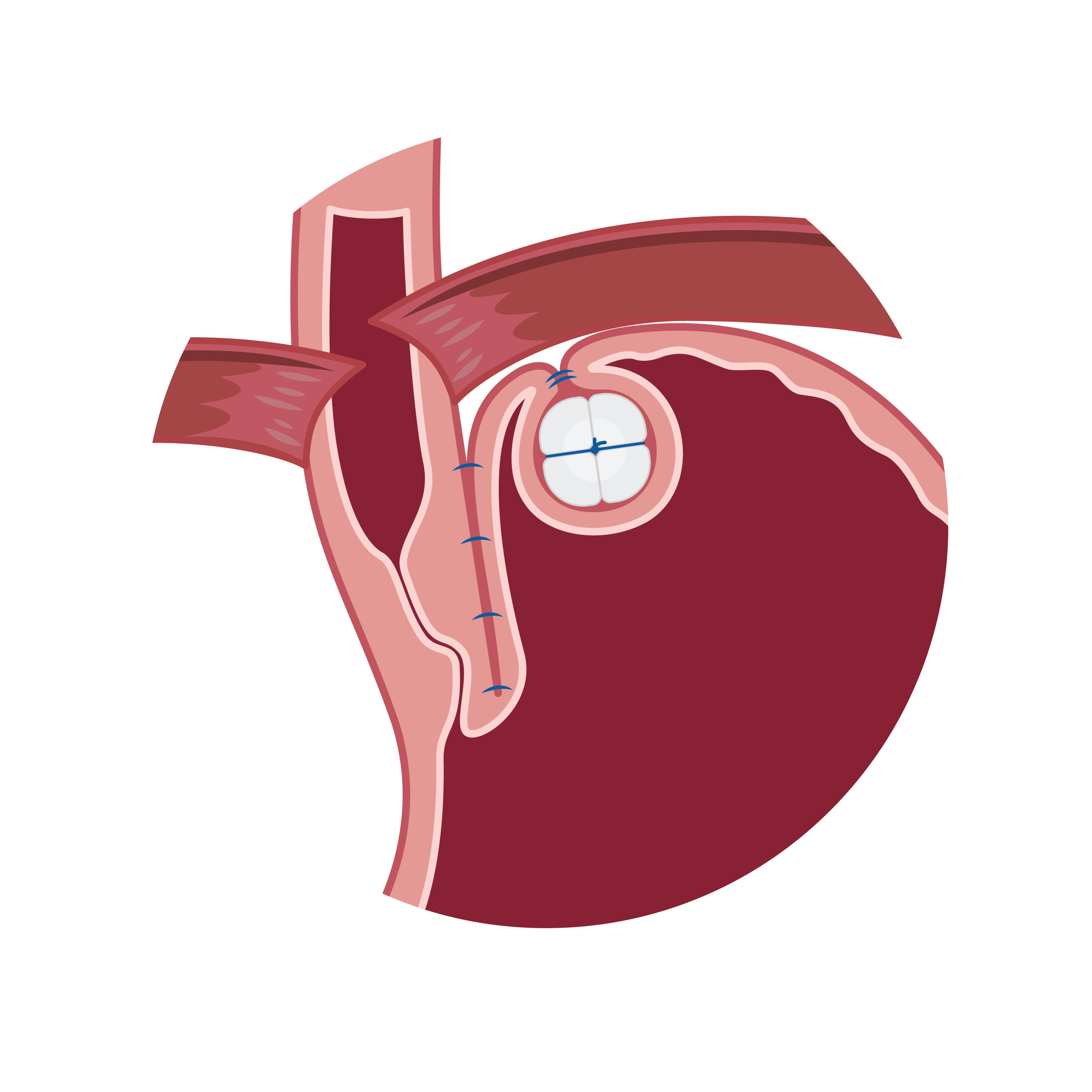 Acid reflux - Implantica